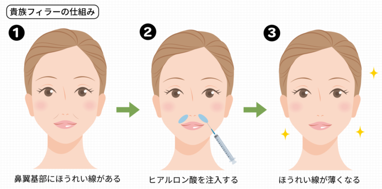 笑顔でほうれい線ができるのはなぜ？｜やめても残る場合の対処法をご紹介 | L’amour clinic Tokyo（ラムールクリニック東京）渋谷院